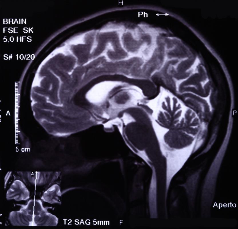 What is fMRI? (with pictures)