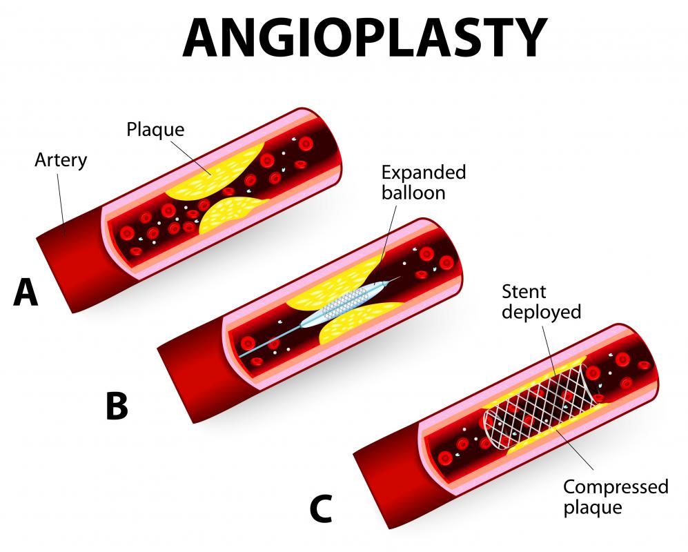 What is Platelet Inhibition? (with pictures)