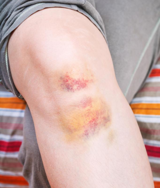 What Is Nitric Oxide? (with pictures)